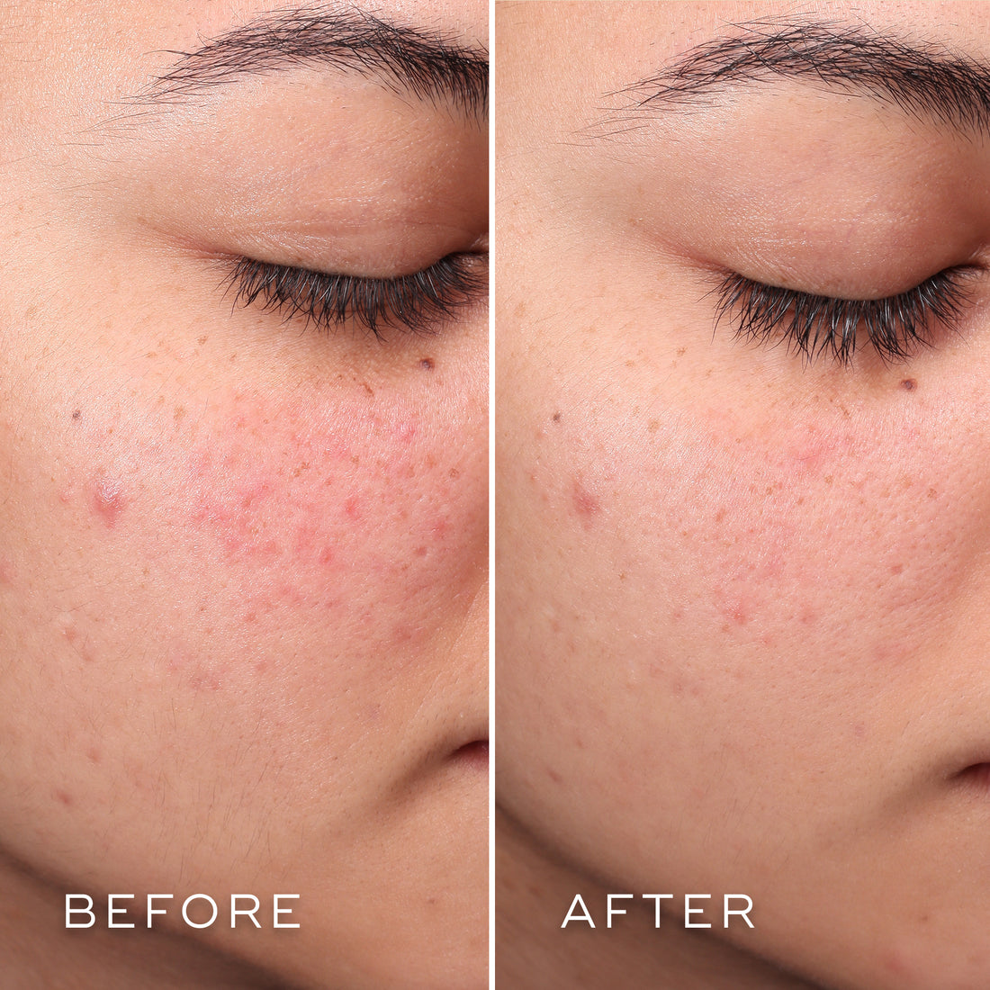 Meet Press & Clear: The BHA Breakthrough You’ve Been Waiting For – Medik8